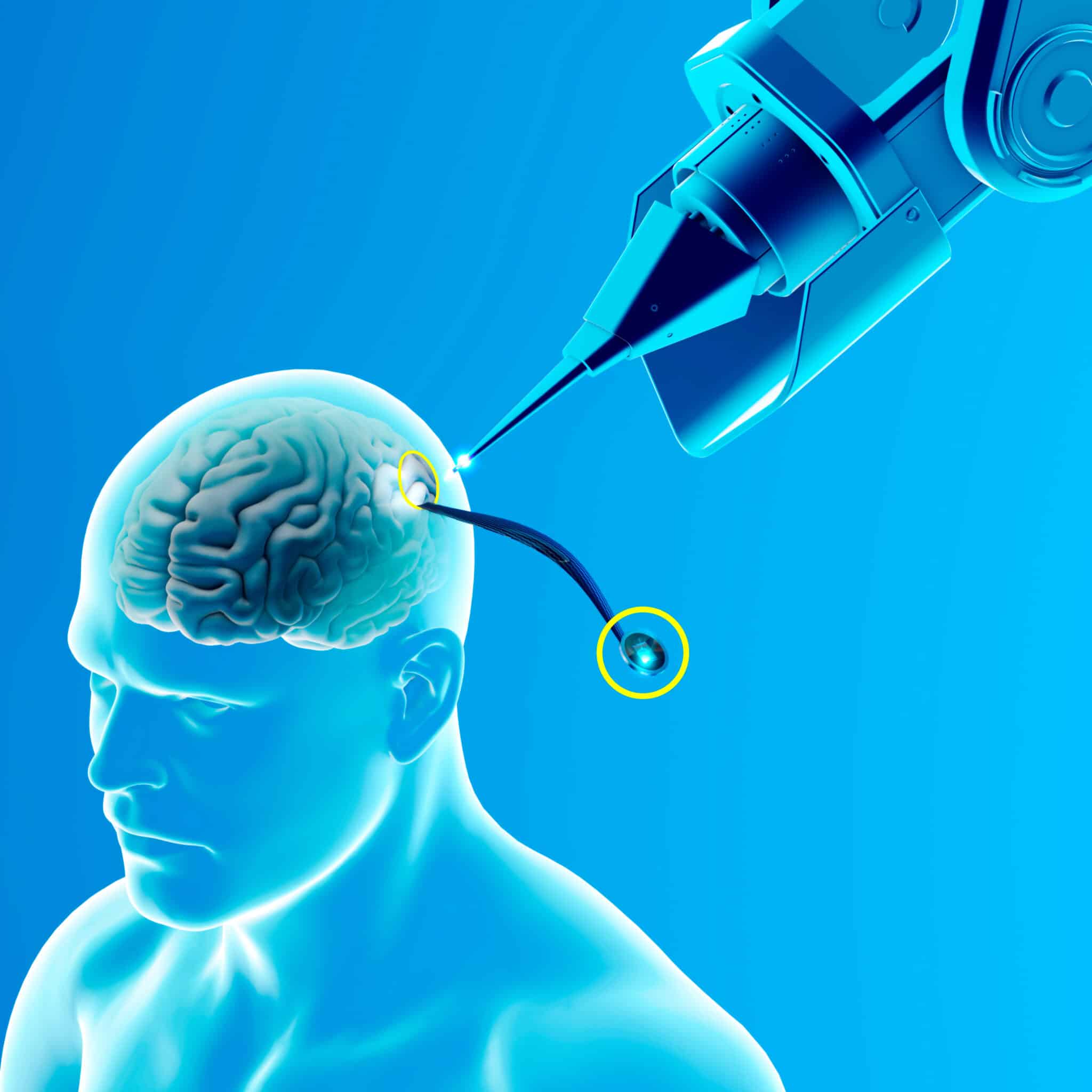 Neuralink : La première puce implantée dans un cerveau humain Neuralink : La première puce implantée dans un cerveau humain